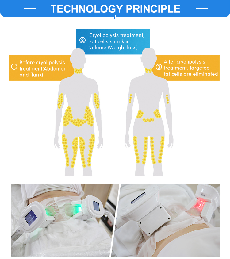 5 in 1 Double Chin And Cellulite Removal Cryo Lipolysis Fat Freeze ...